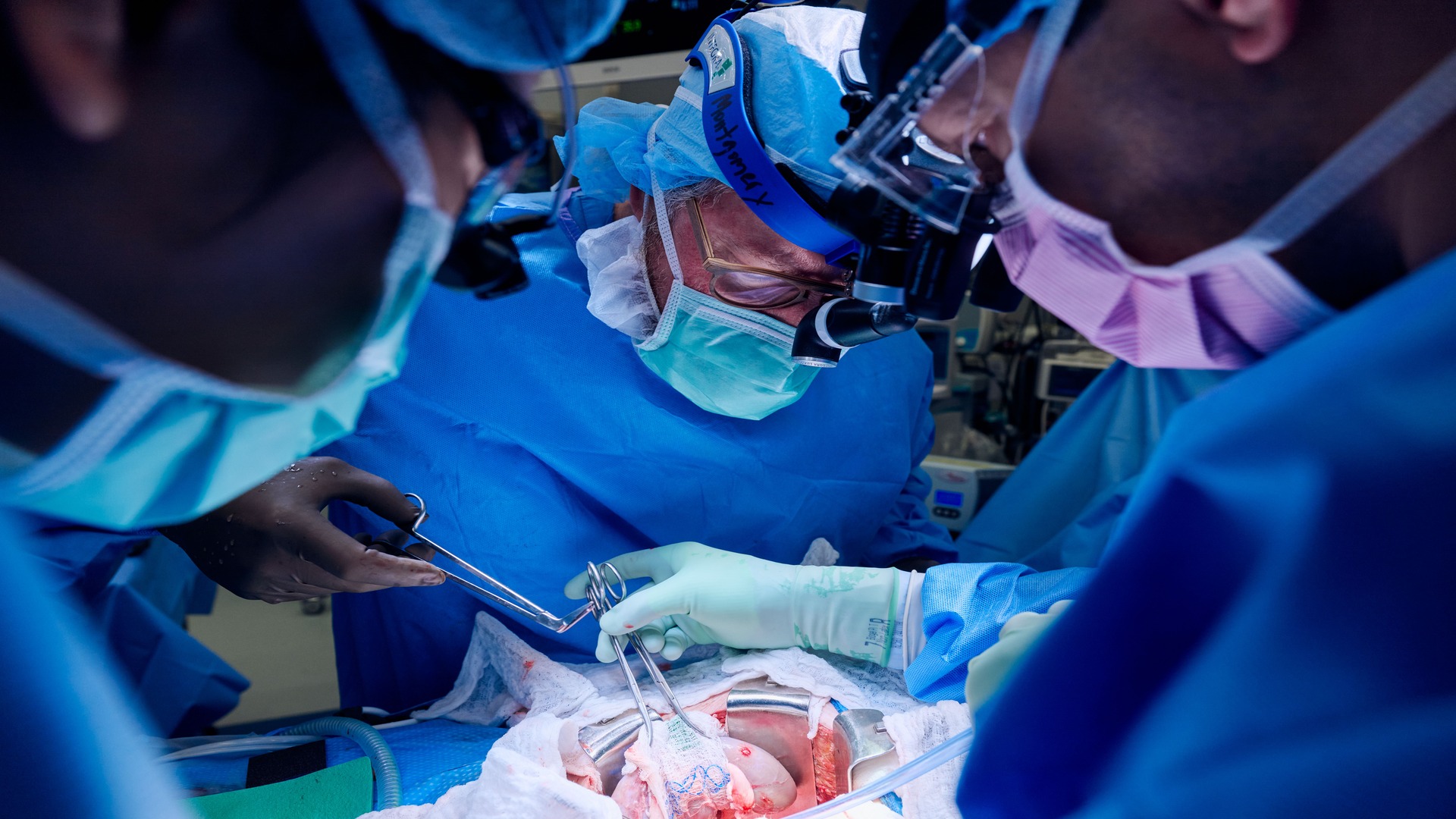 First combined heart pump and pig kidney transplant successful