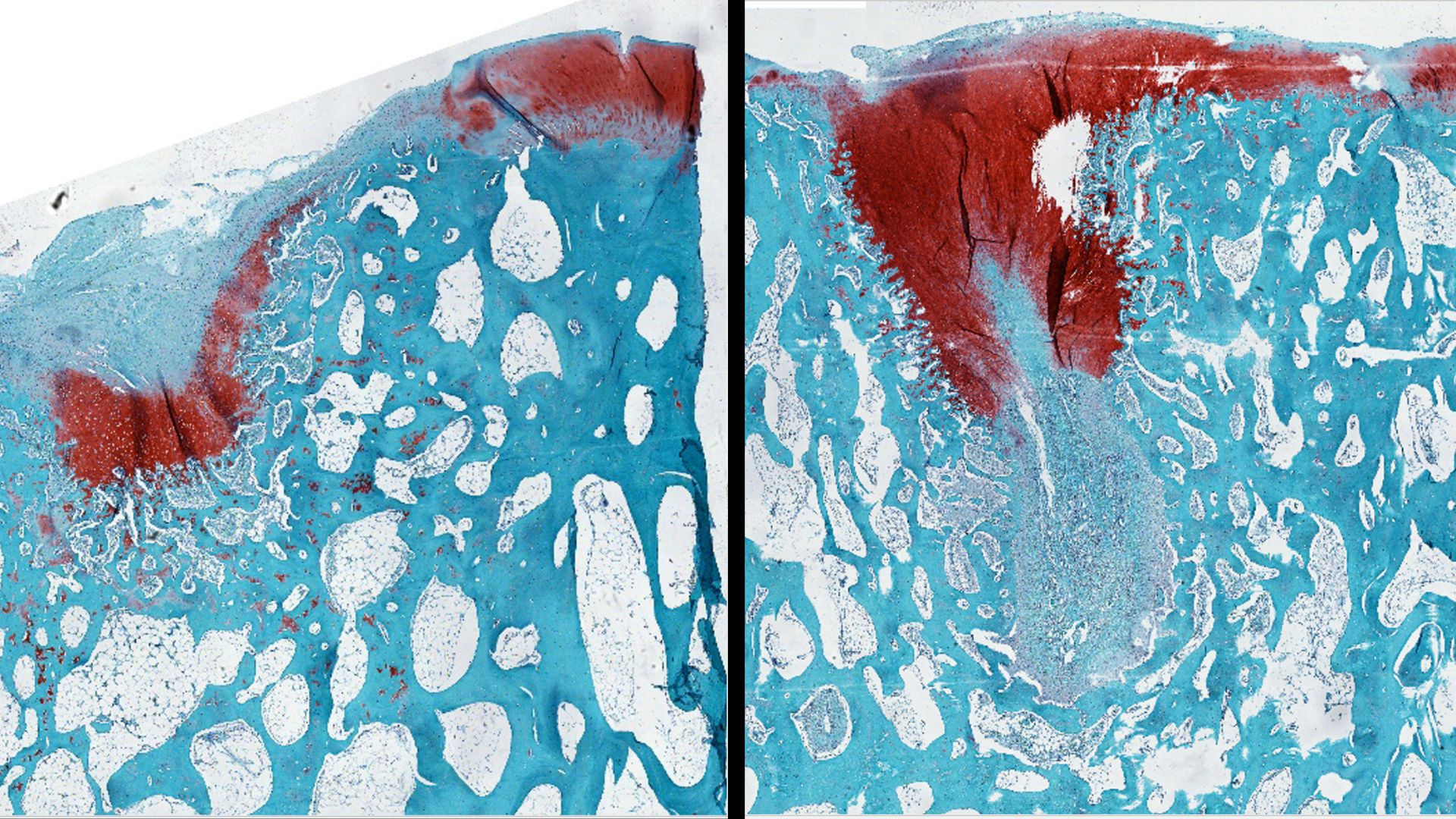 Breakthrough biomaterial regenerates knee cartilage in 6 months