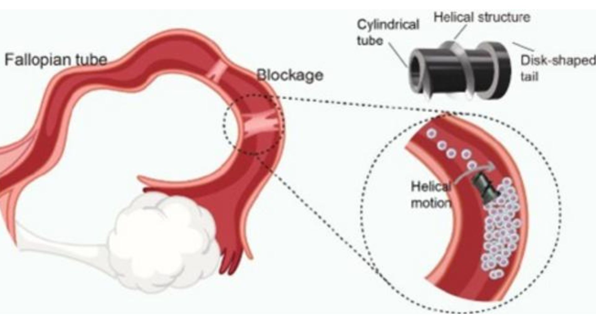 Magnetic robot offers hope for treating fallopian tube blockages
