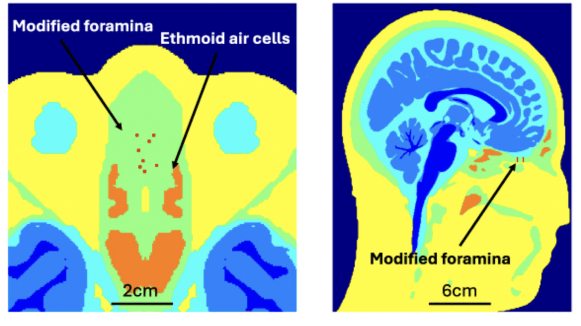 DeepFocus: Nasal electrodes to target depression, addiction, PTSD