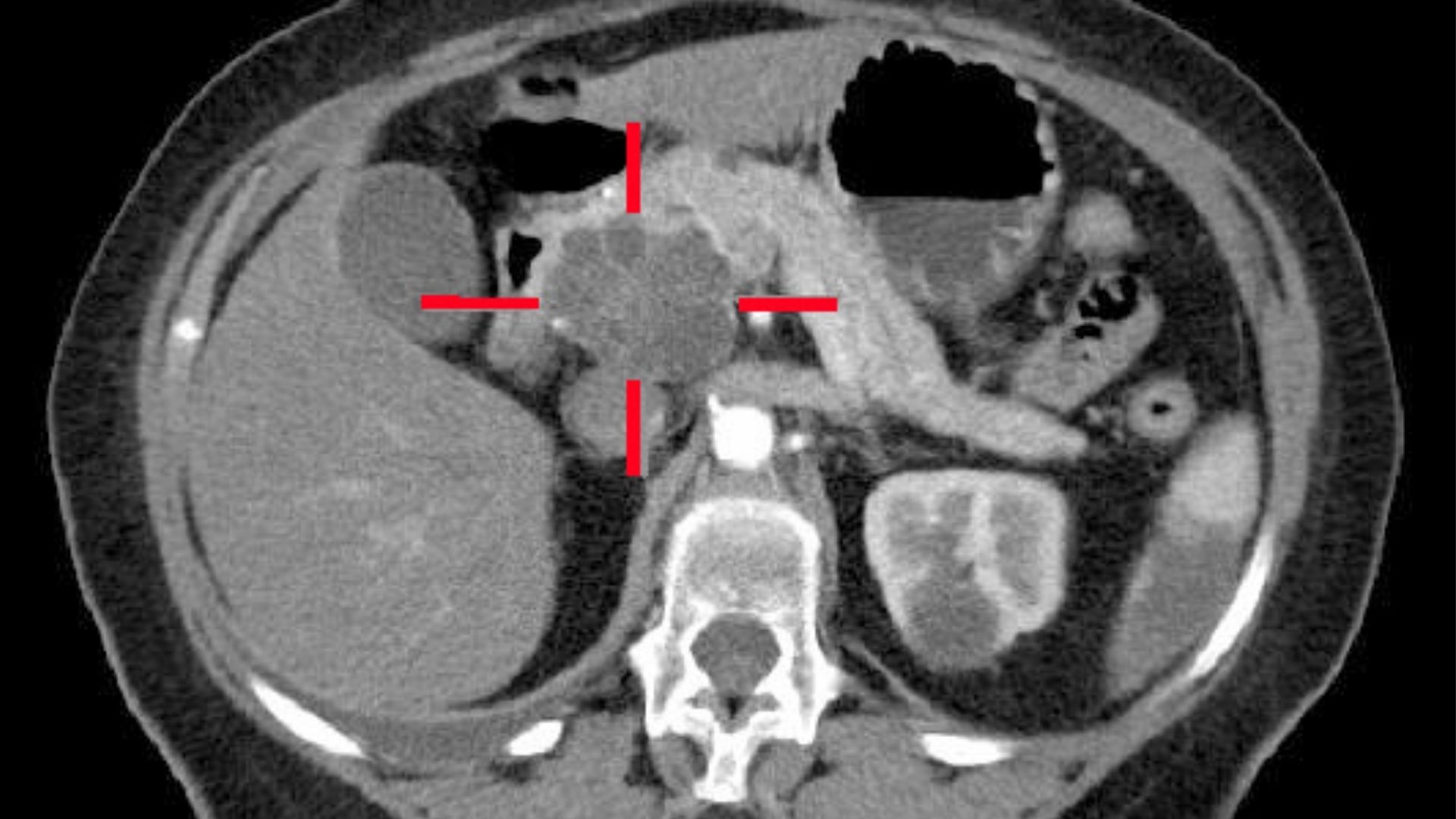10 deadliest cancers in the world by survival rate
